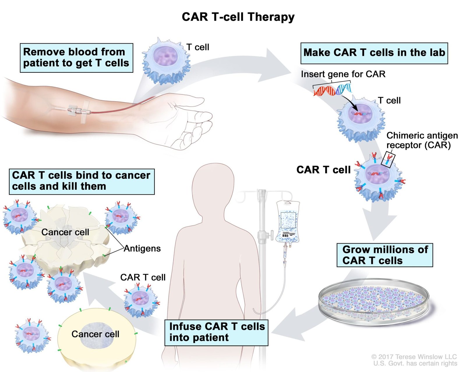 CAR-T Cell Therapy for Cancer Treatment